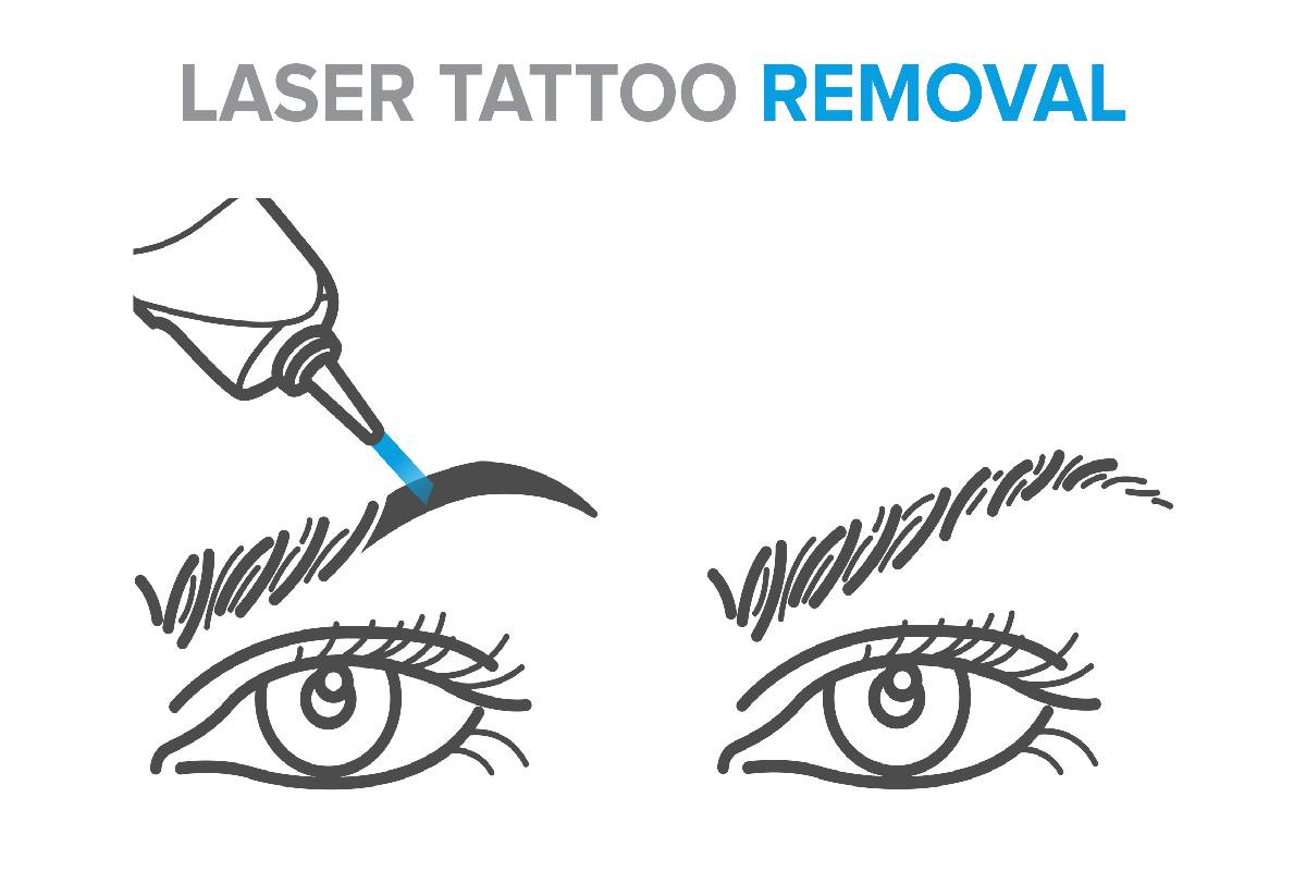 Microblading Removal | Lexington Tattoo Removal
