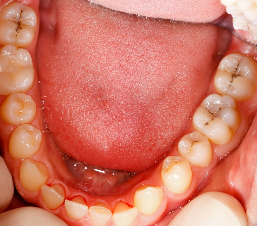What Is Tooth Scaling