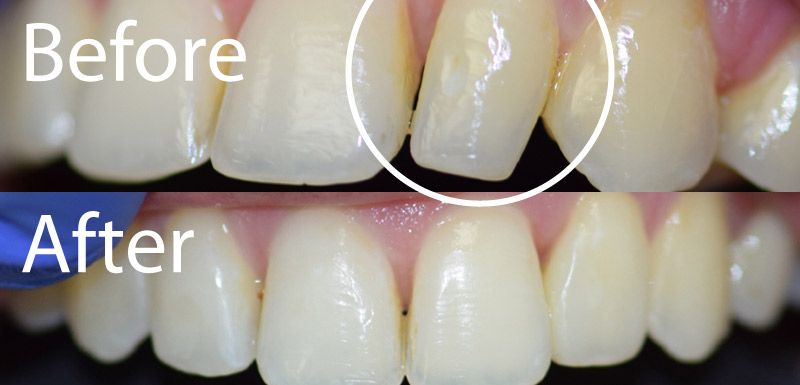 Peg Lateral Small Tooth Correction Dental Restoration