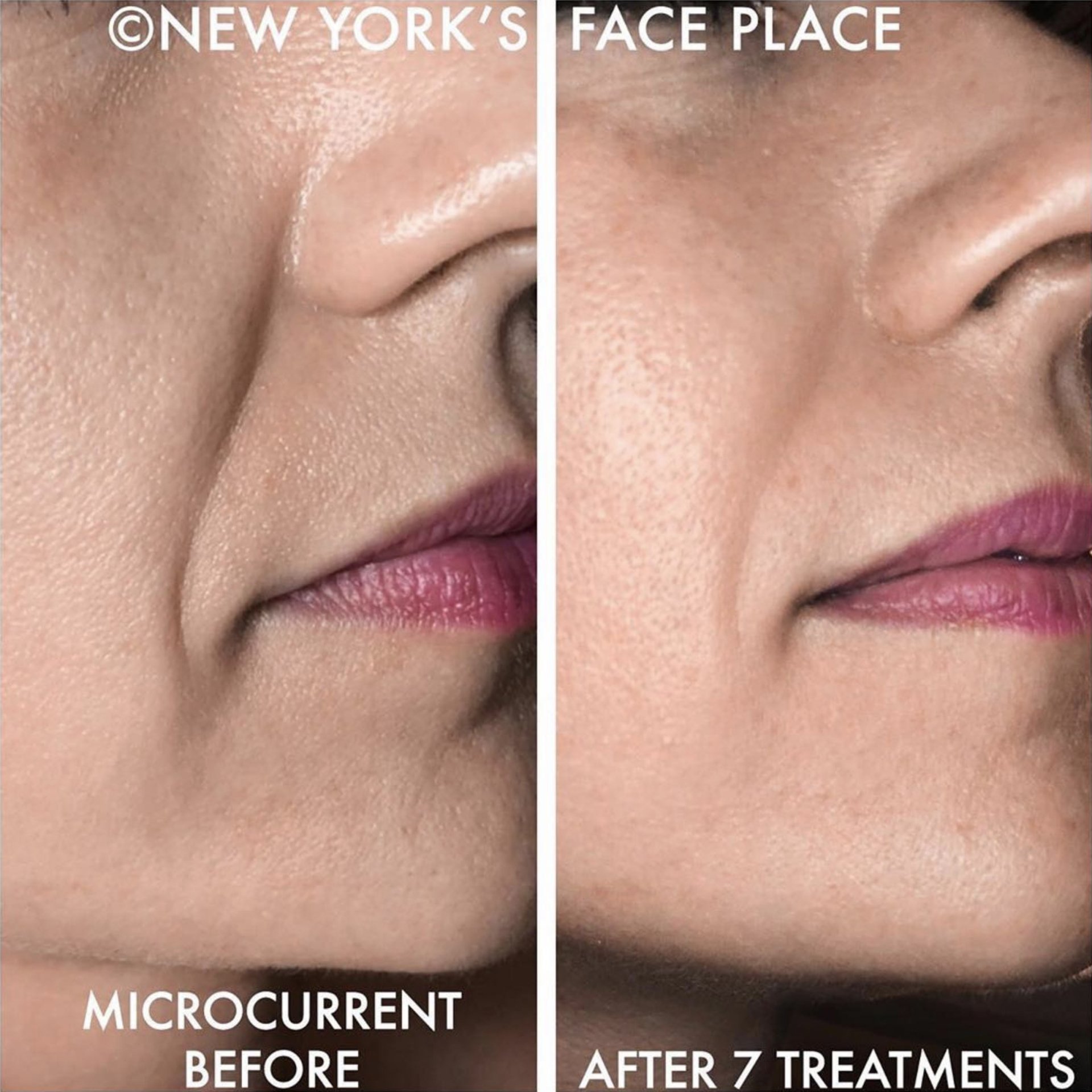 Before & After | Advanced Microcurrent Science for Anti-Aging