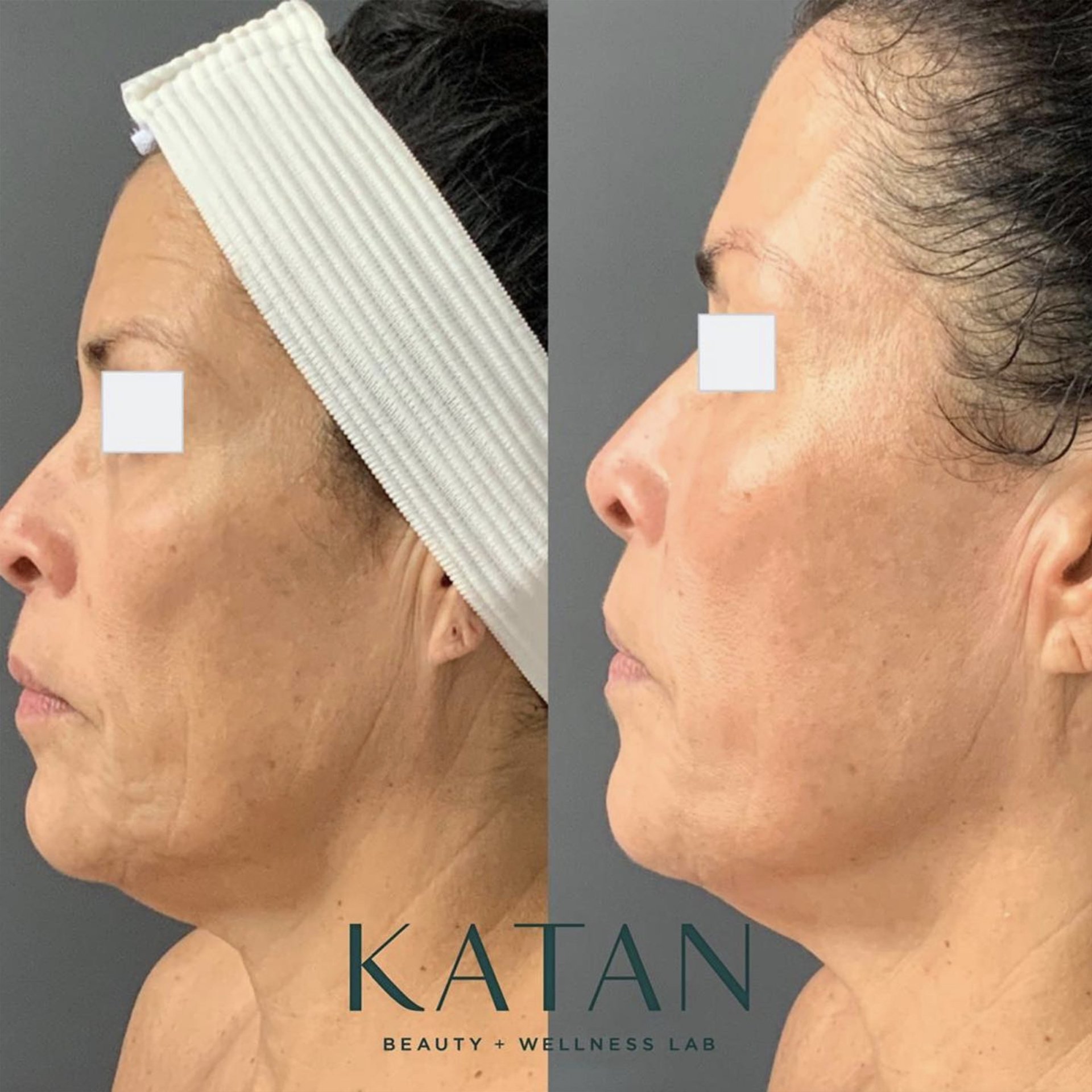 Before & After | Advanced Microcurrent Science for Anti-Aging