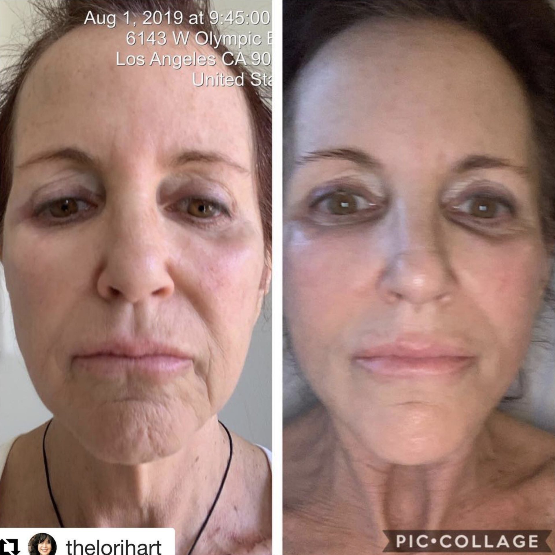 Before & After | Advanced Microcurrent Science for Anti-Aging