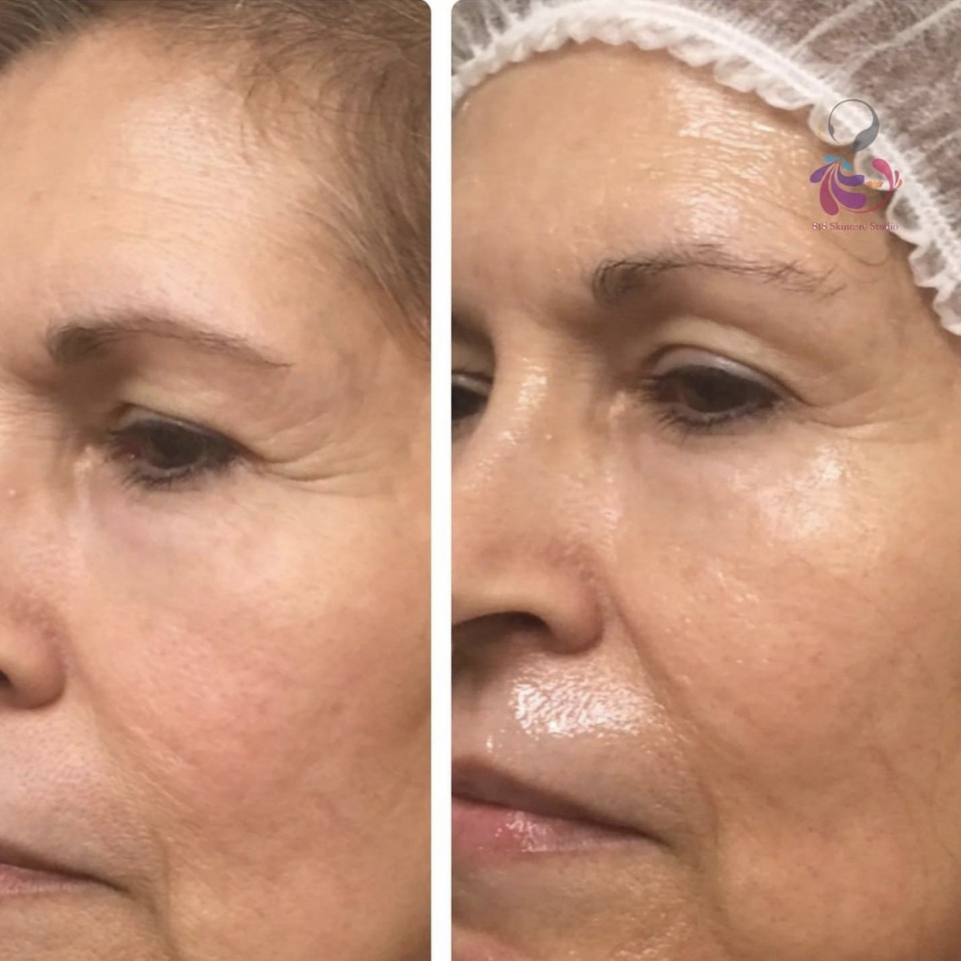 Before & After | Advanced Microcurrent Science for Anti-Aging