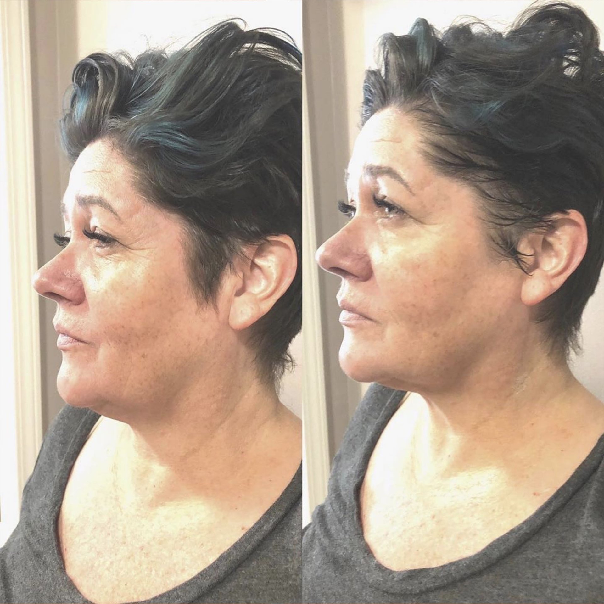 Before & After | Advanced Microcurrent Science for Anti-Aging