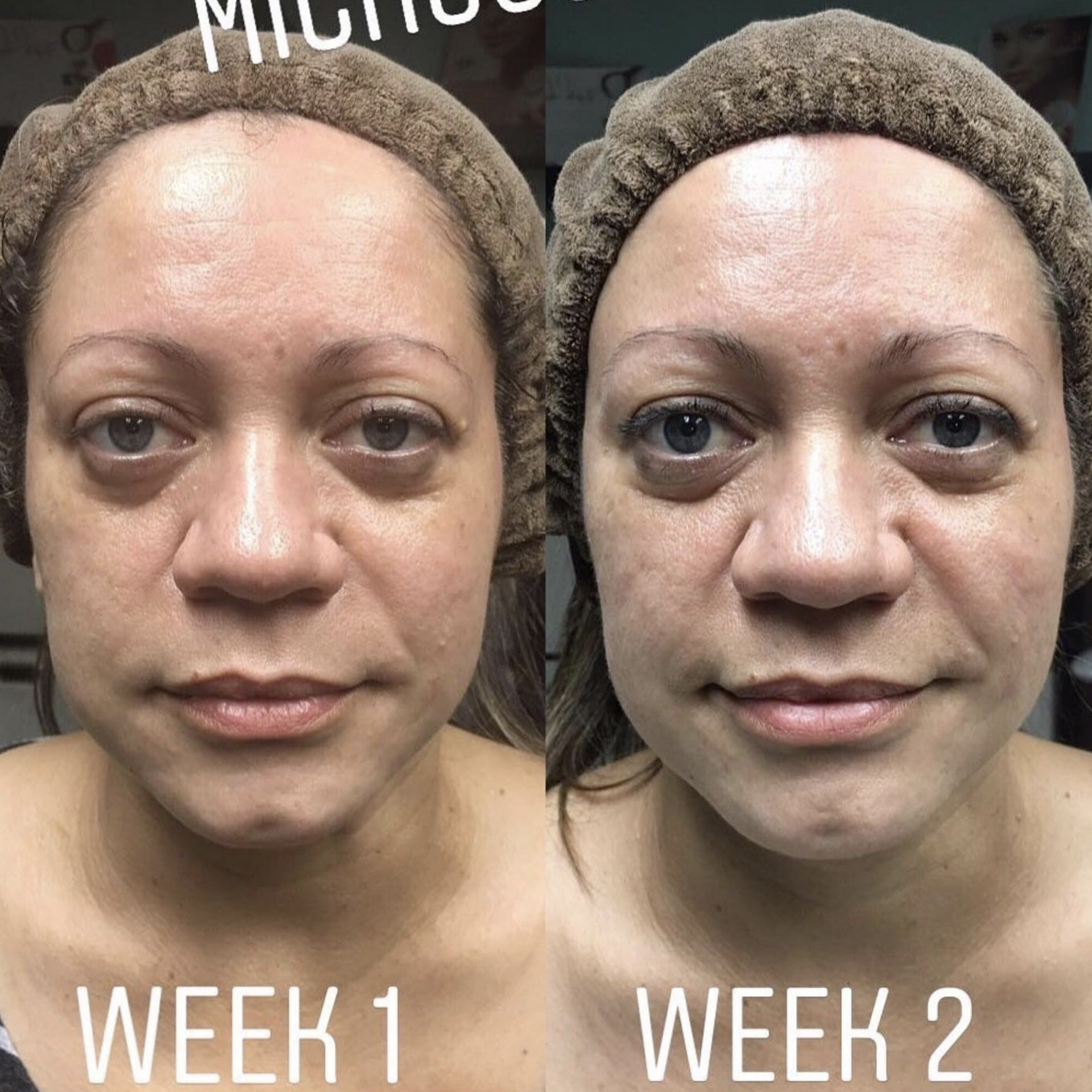 Before & After | Advanced Microcurrent Science for Anti-Aging