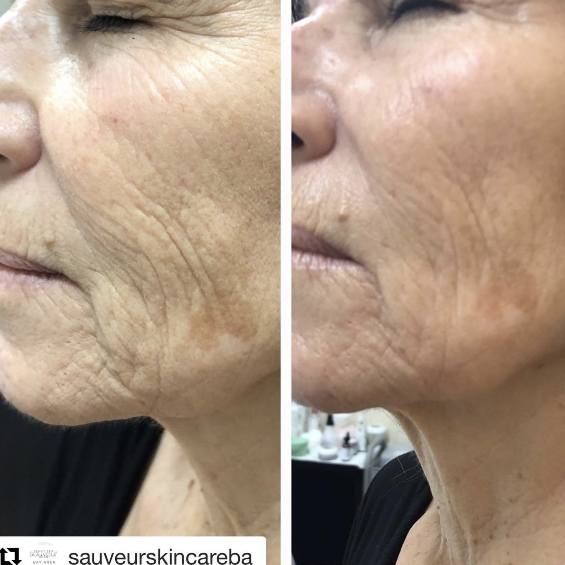 Before & After | Advanced Microcurrent Science for Anti-Aging