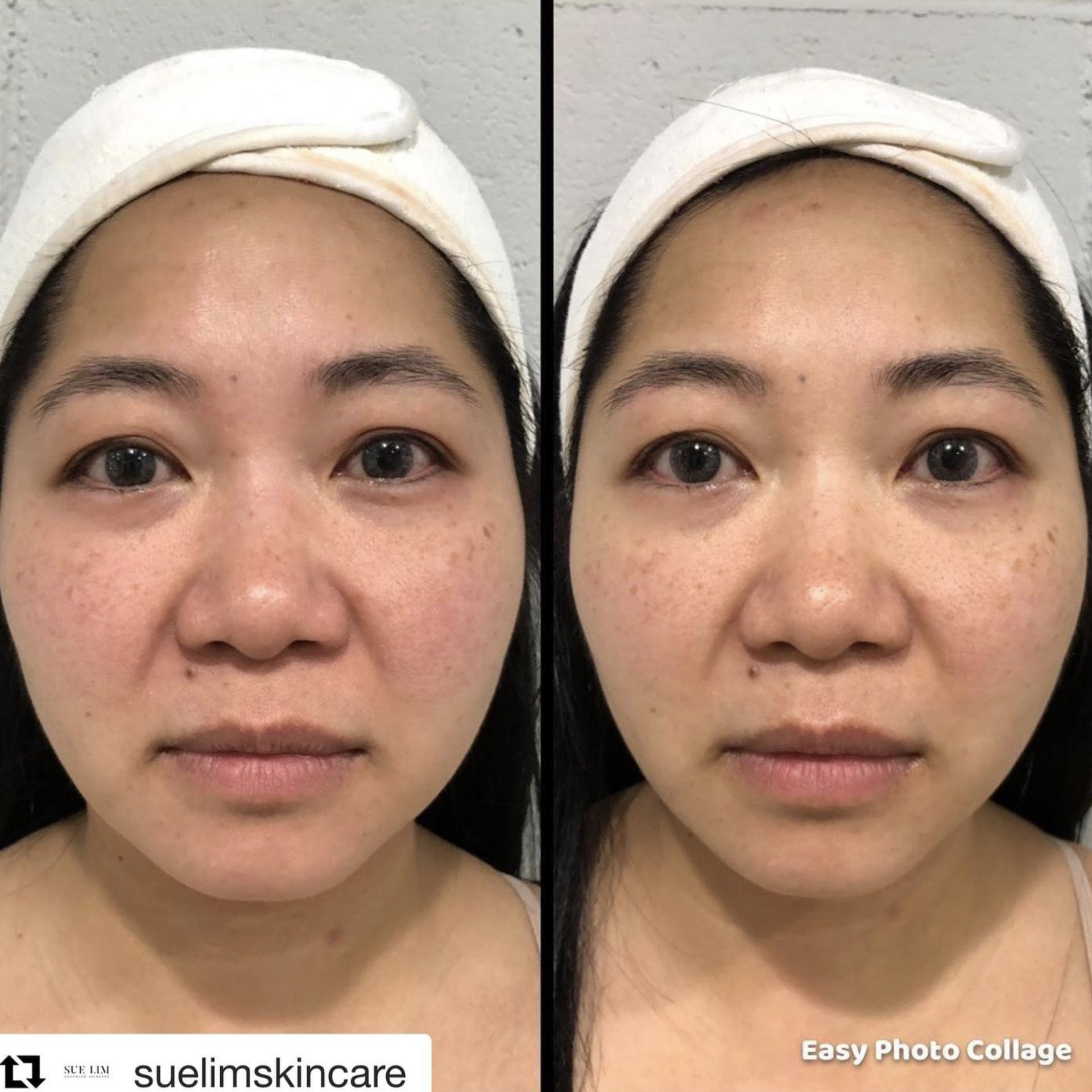 Before & After | Advanced Microcurrent Science for Anti-Aging