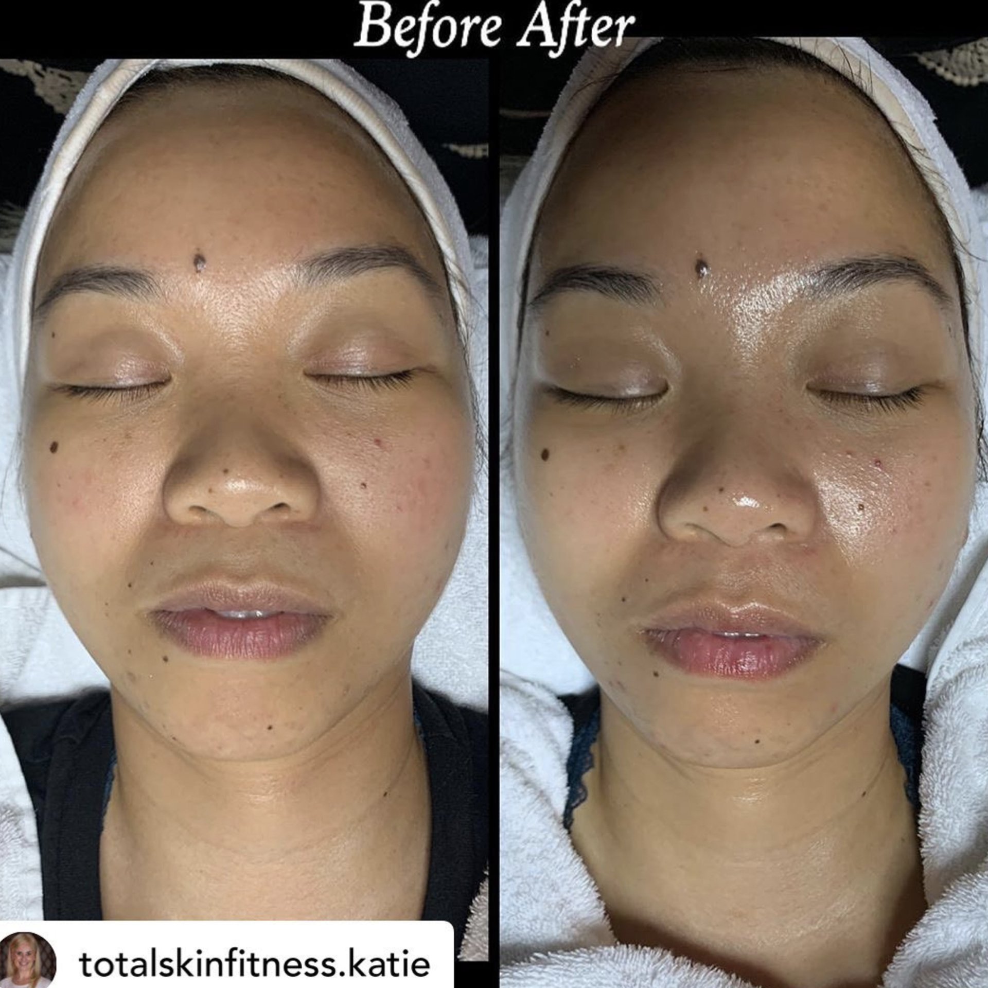 Before & After | Advanced Microcurrent Science for Anti-Aging