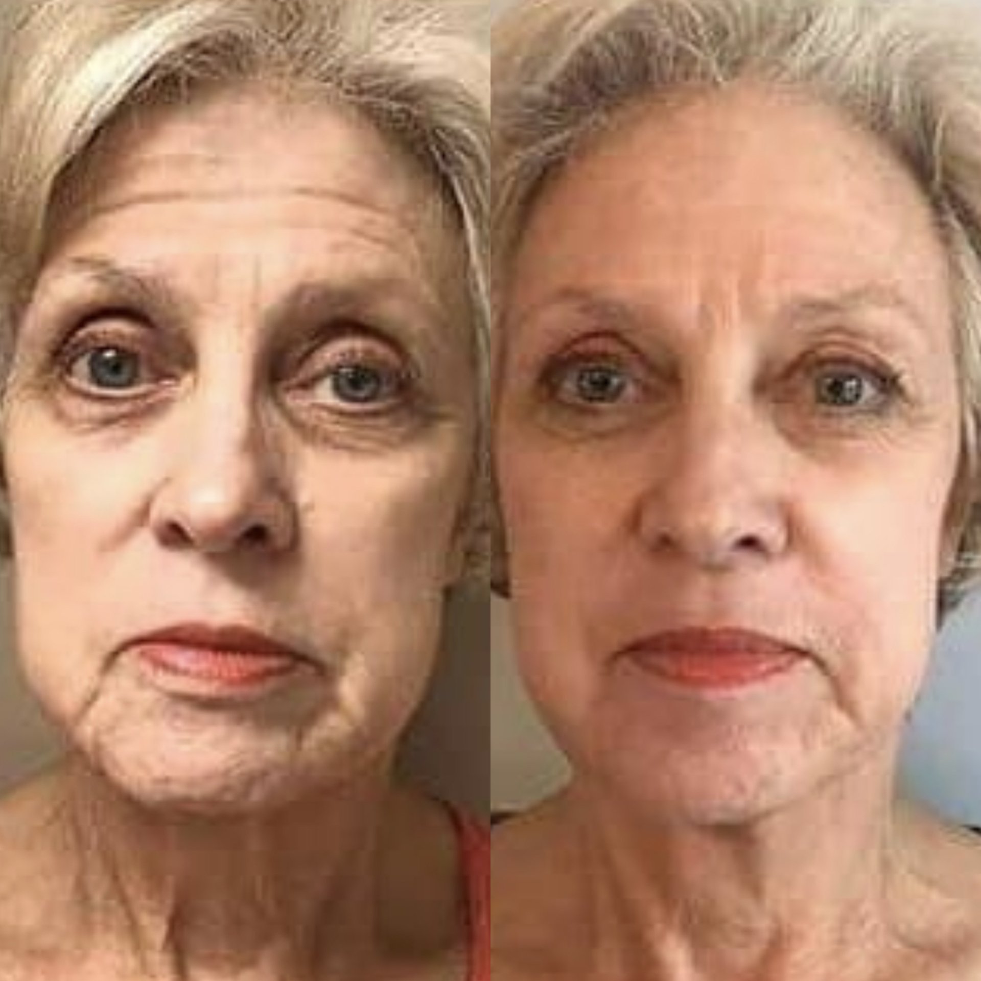 Before & After | Advanced Microcurrent Science for Anti-Aging