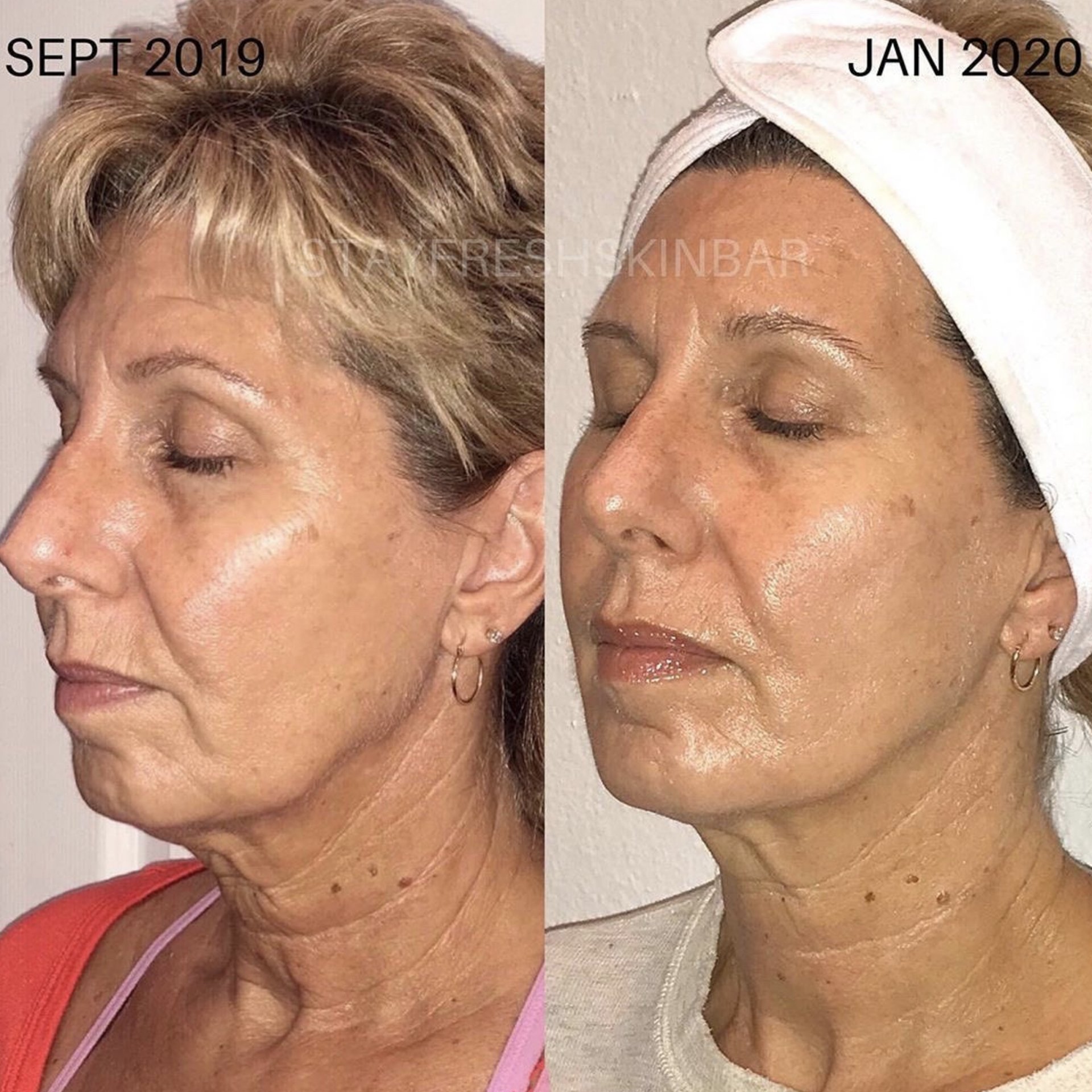 Before & After | Advanced Microcurrent Science for Anti-Aging