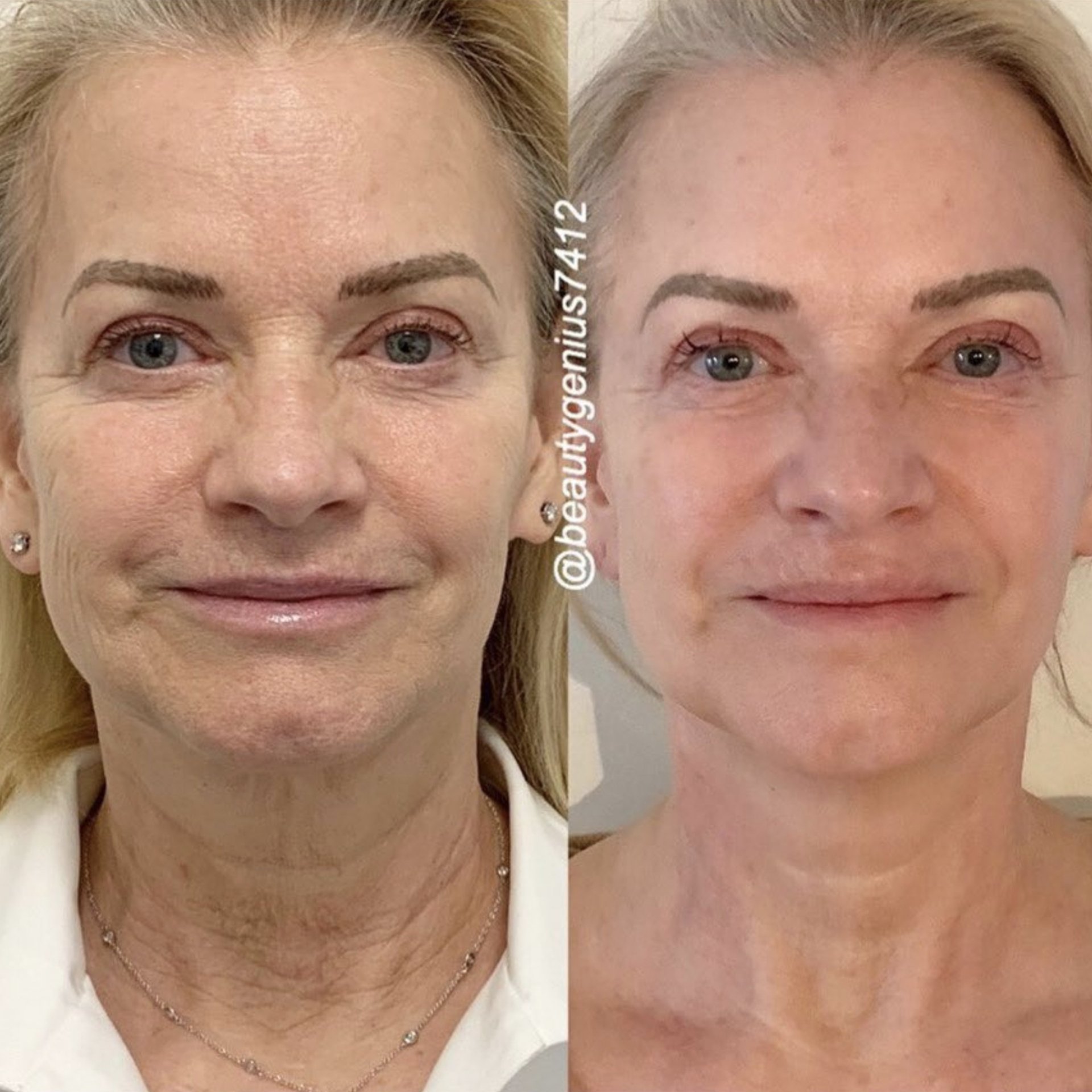 Before & After | Advanced Microcurrent Science for Anti-Aging