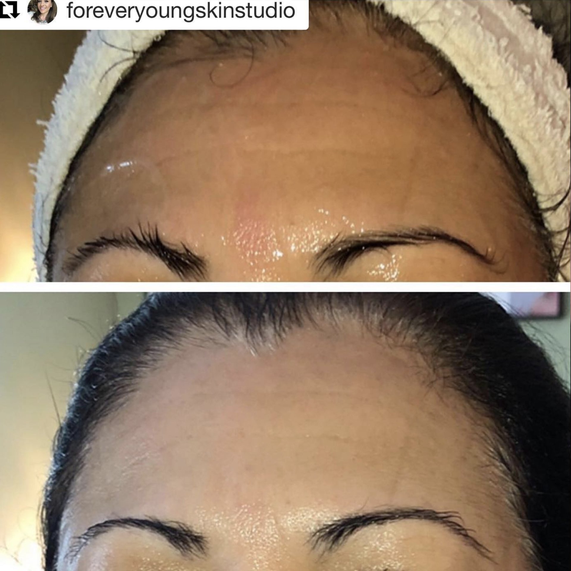 Before & After | Advanced Microcurrent Science for Anti-Aging