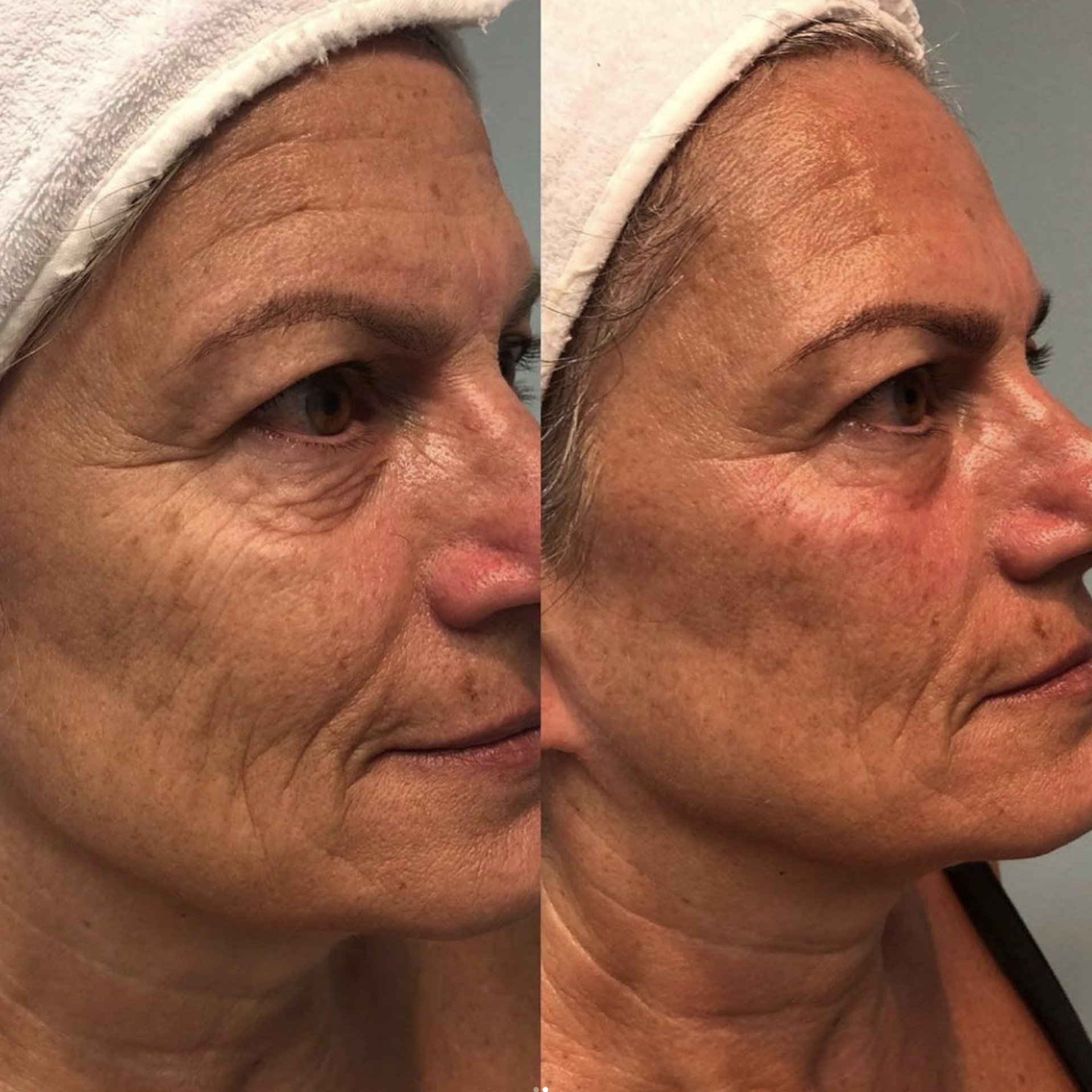 Before & After | Advanced Microcurrent Science for Anti-Aging
