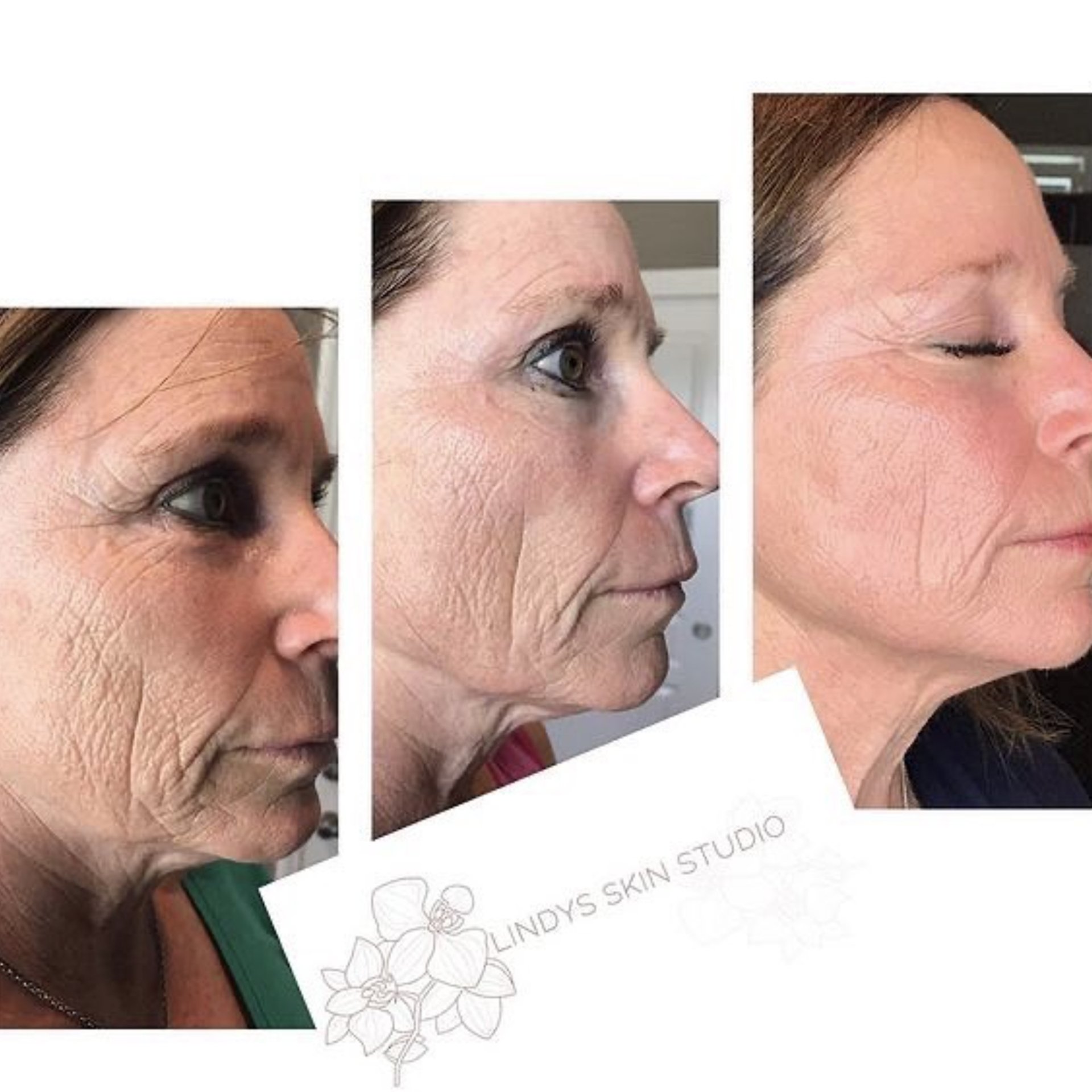 Before & After | Advanced Microcurrent Science for Anti-Aging