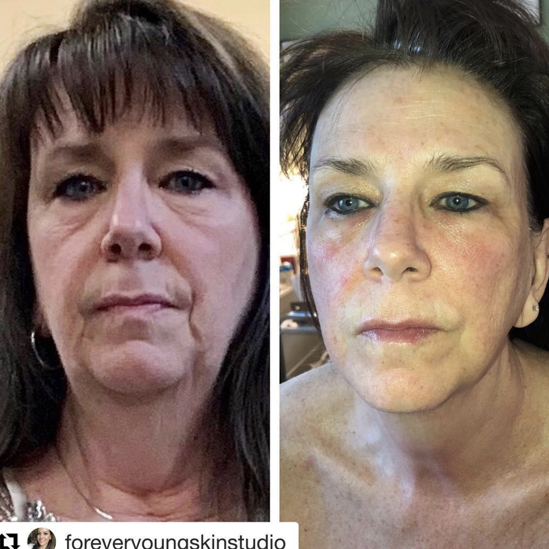 Before & After | Advanced Microcurrent Science for Anti-Aging