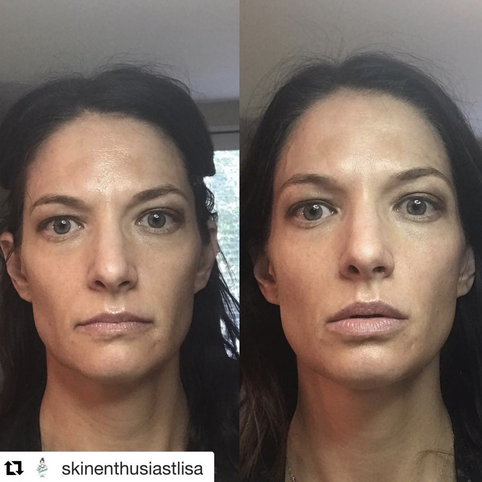 Before & After | Advanced Microcurrent Science for Anti-Aging