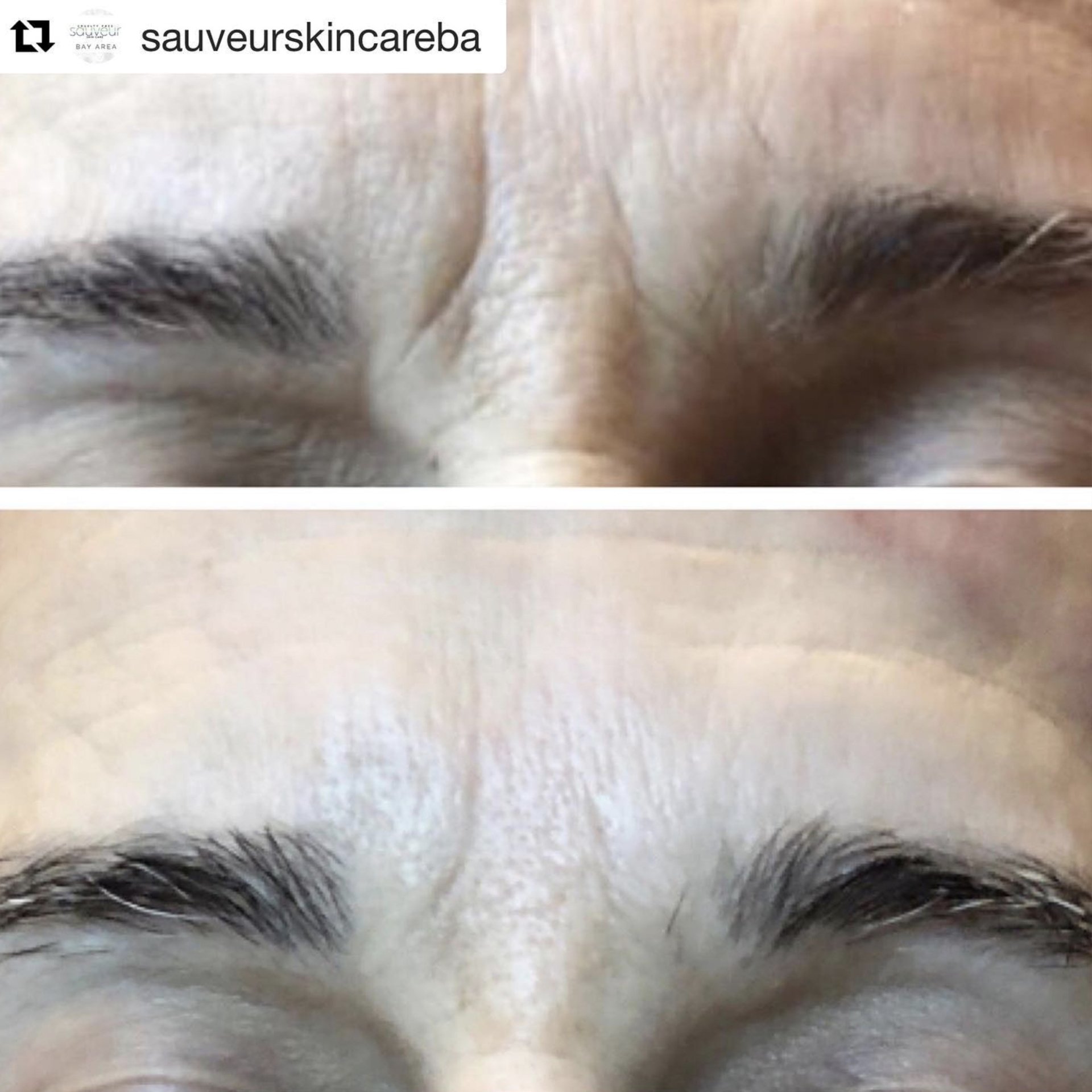 Before & After | Advanced Microcurrent Science for Anti-Aging