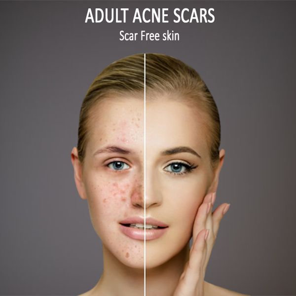 Adult Acne Scar Treatments That Work | Malka Spa