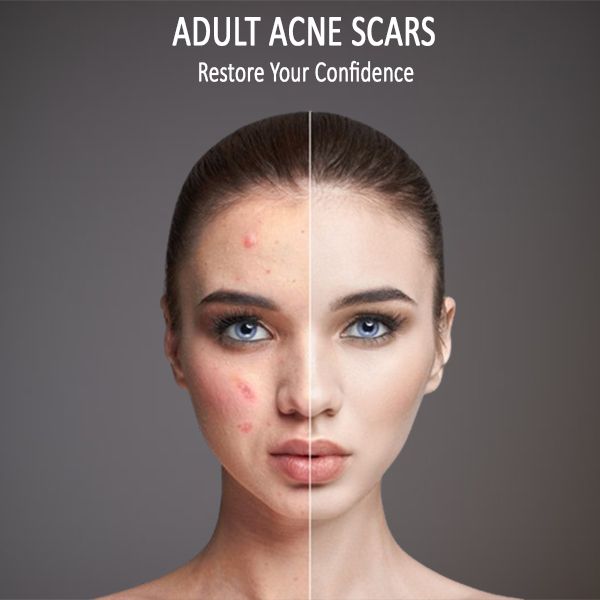 Adult Acne Scar Treatments That Work | Malka Spa