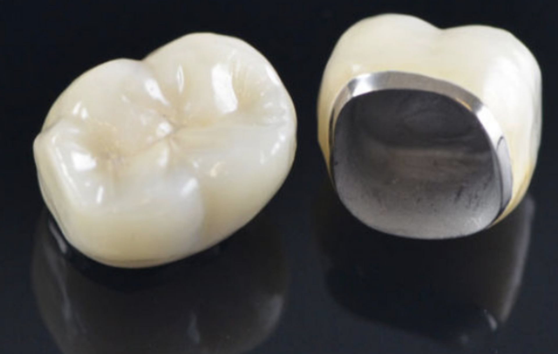 Premium Porcelain-Fused-to-Metal (PFM) Restorations | Wichita, KS