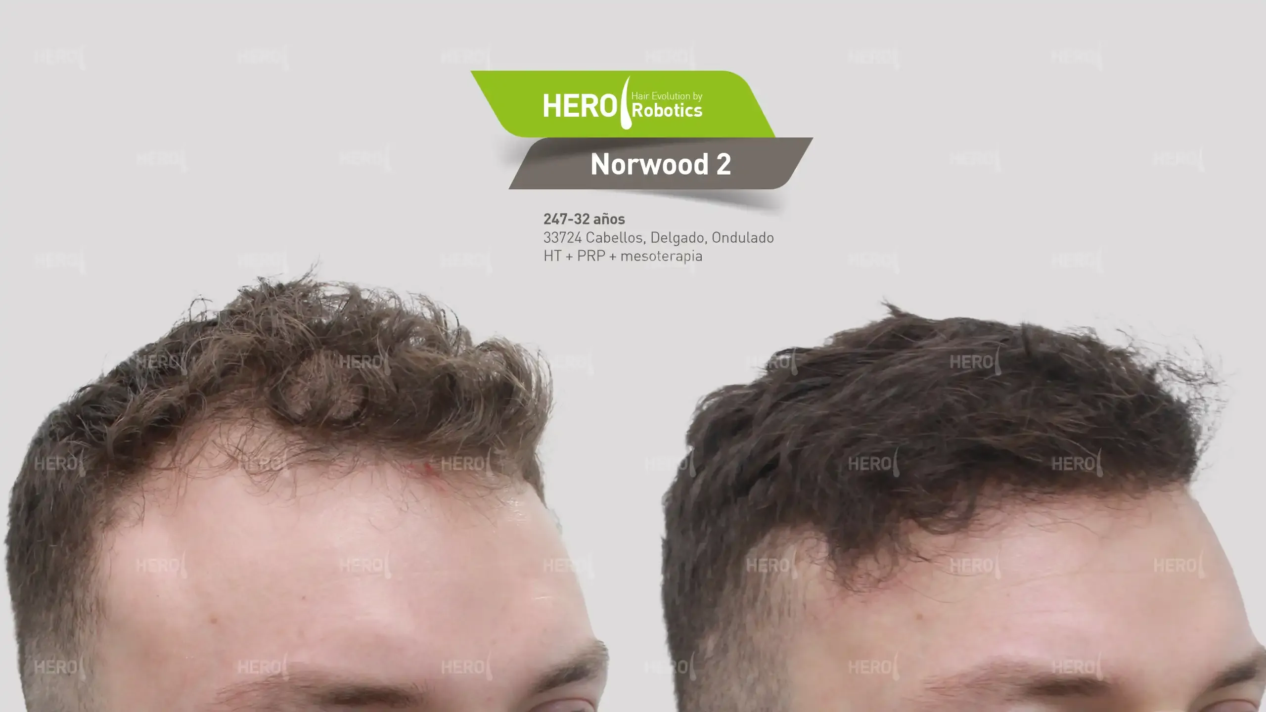 Understanding Norwood Level 2 Hair Loss in 2024