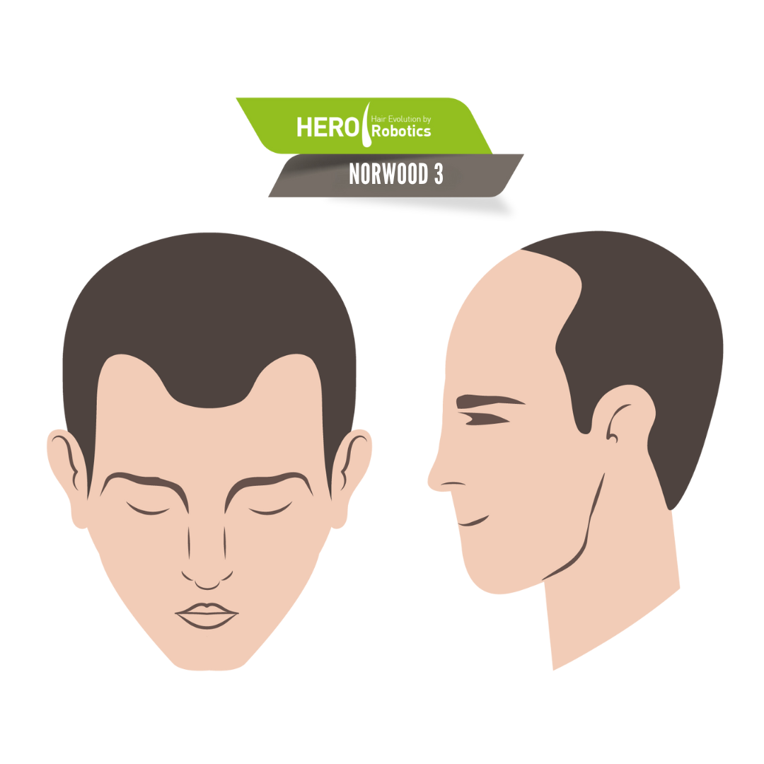 Hair Transplant Colombia | HERO Institute