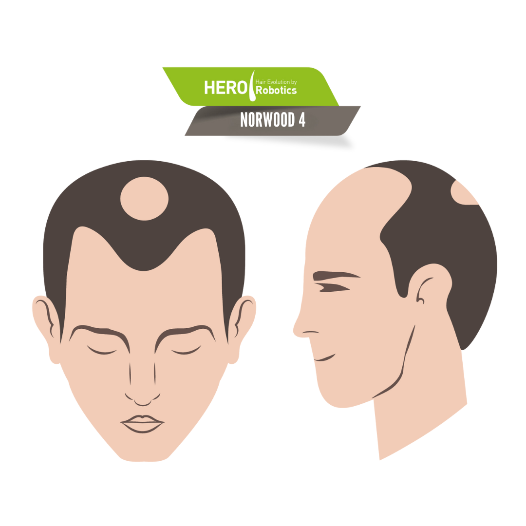 Hair Transplant Colombia | HERO Institute