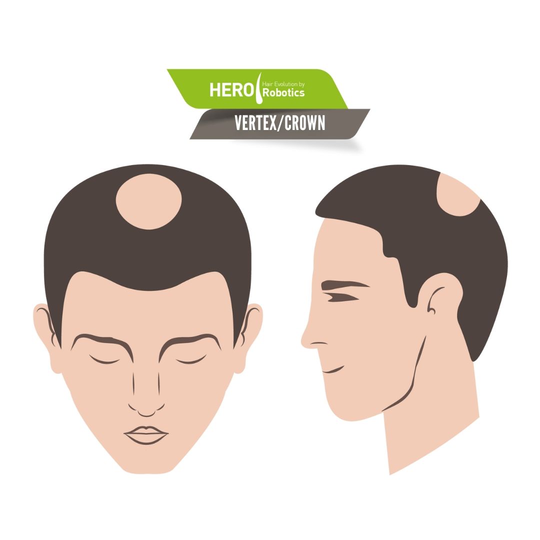 Vertex Alopecia: Causes and Treatments for Crown Hair Loss