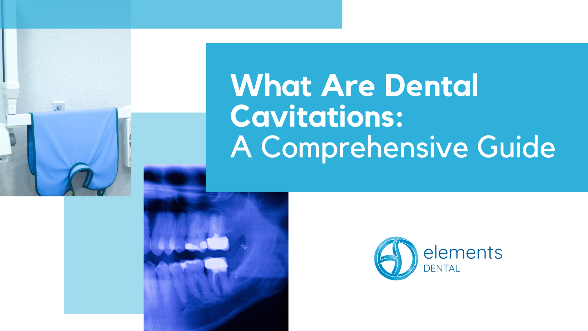 What Are Dental Cavitations: A Comprehensive Guide