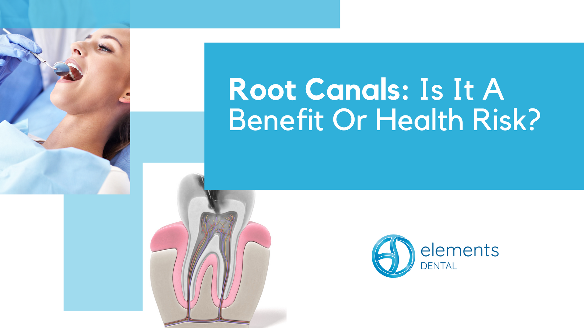 Root Canals: Is It A Benefit Or Health Risk?