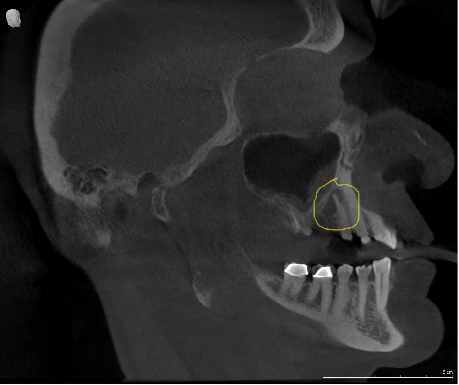 What Are Dental Cavitations: A Comprehensive Guide