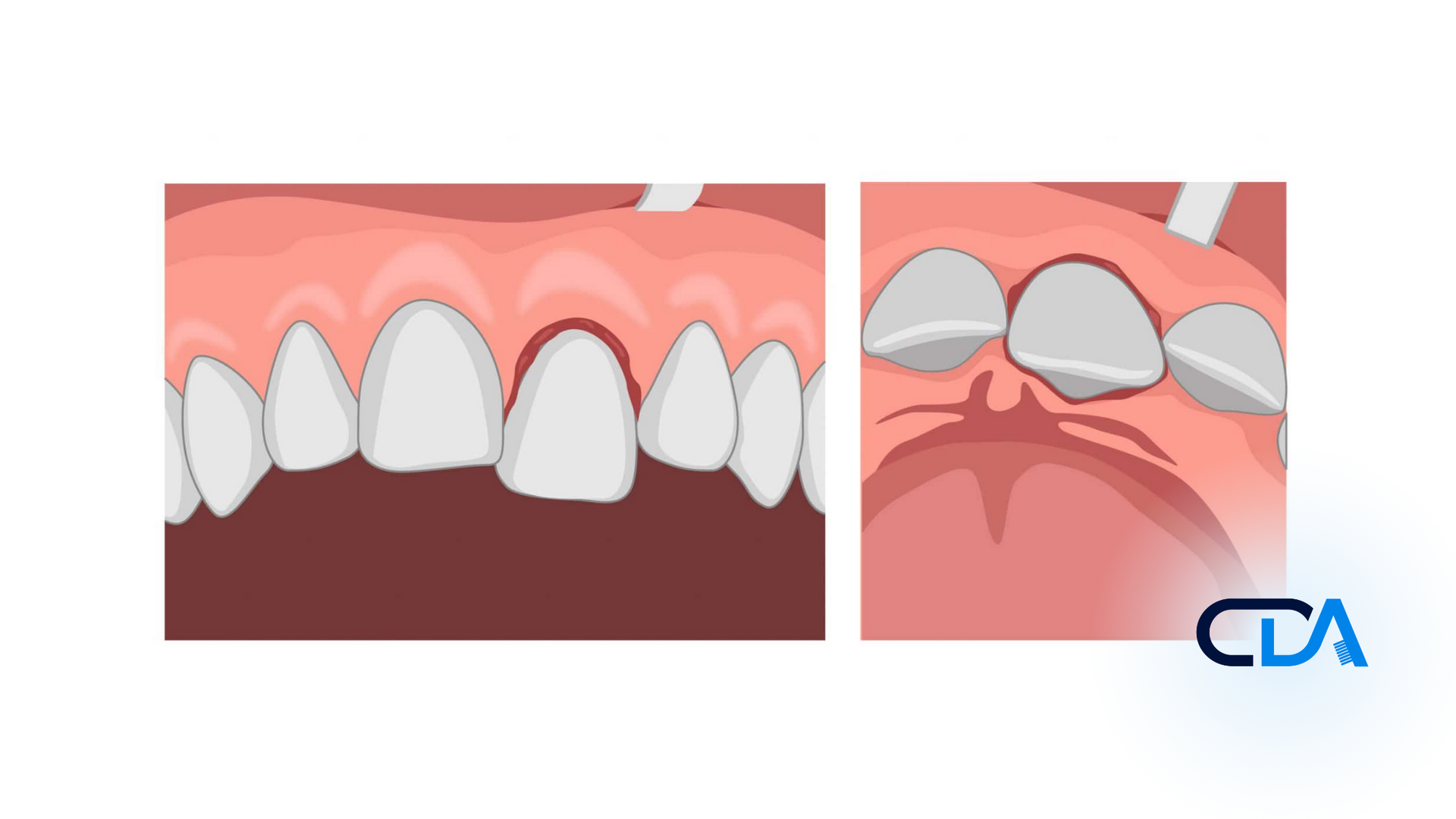 Tooth Luxation: Types, Causes, Symptoms, and Treatment