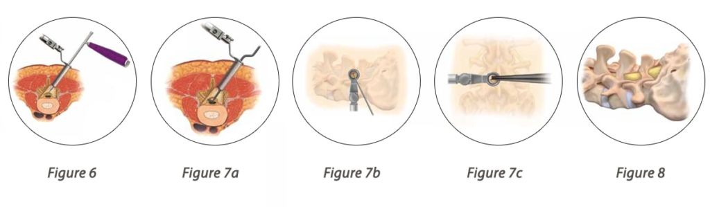 Medtronic Metrx system - MD Spine Care - San Antonio Texas