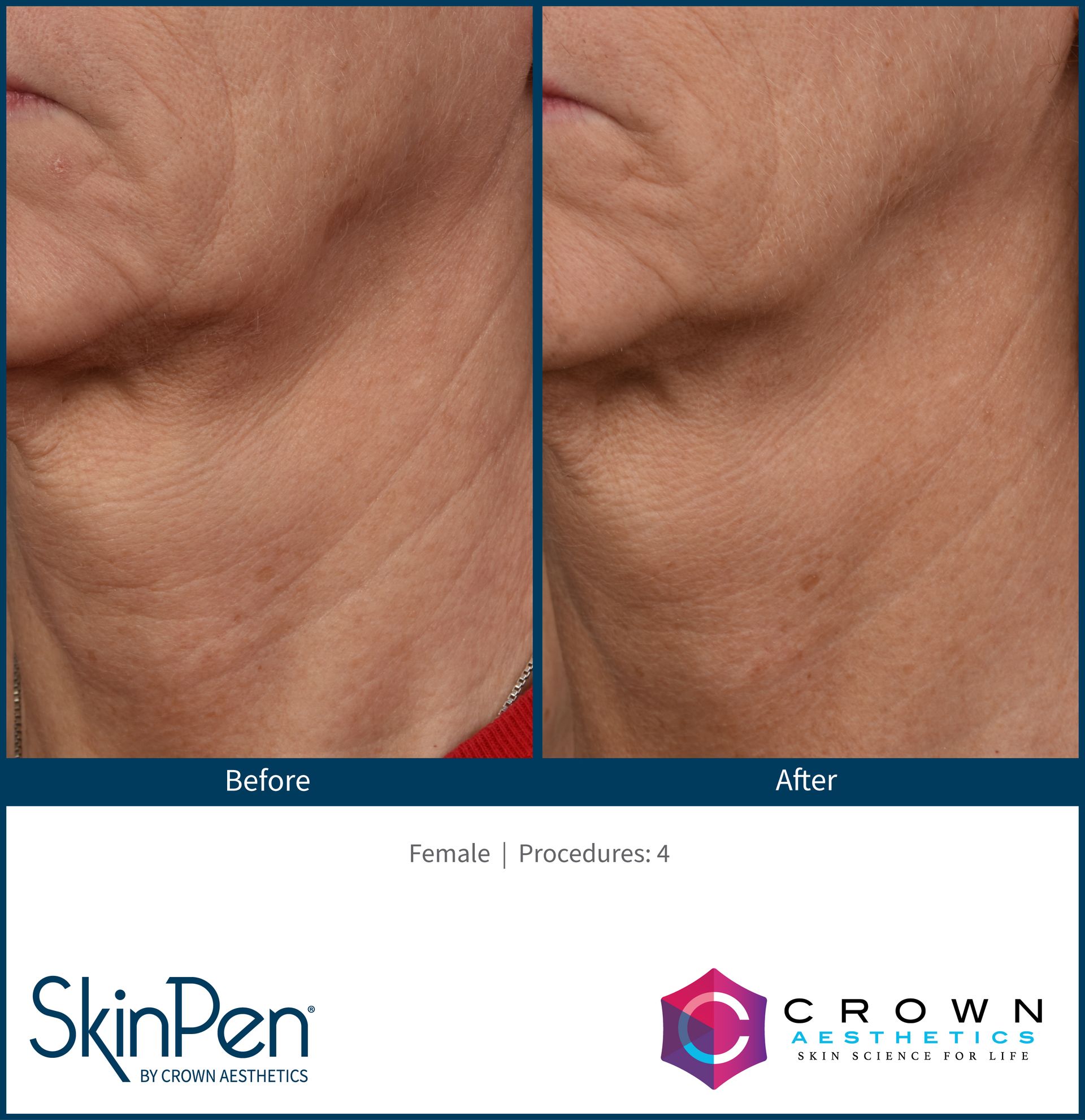 Microneedling | Women4Women OBGYN - Huntsville
