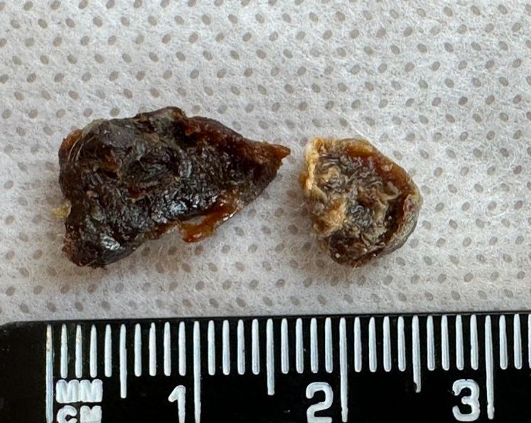 Ear Wax Removal Coventry - Specialists in syringing µosuction