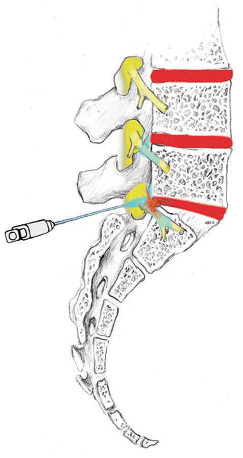 Lumbar Transforaminal Epidural Steroid Injection