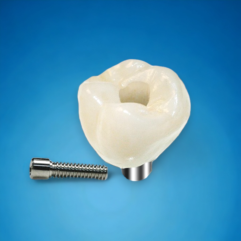 Screw Retained Crowns - Summit-Horizon Dental Lab
