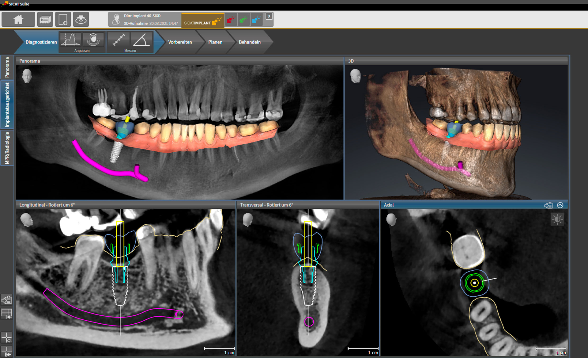 Digital Implant Treatment Planning | Restorative-Driven Workflow