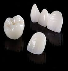 E-Max Crowns | Summit-Horizon Dental Lab