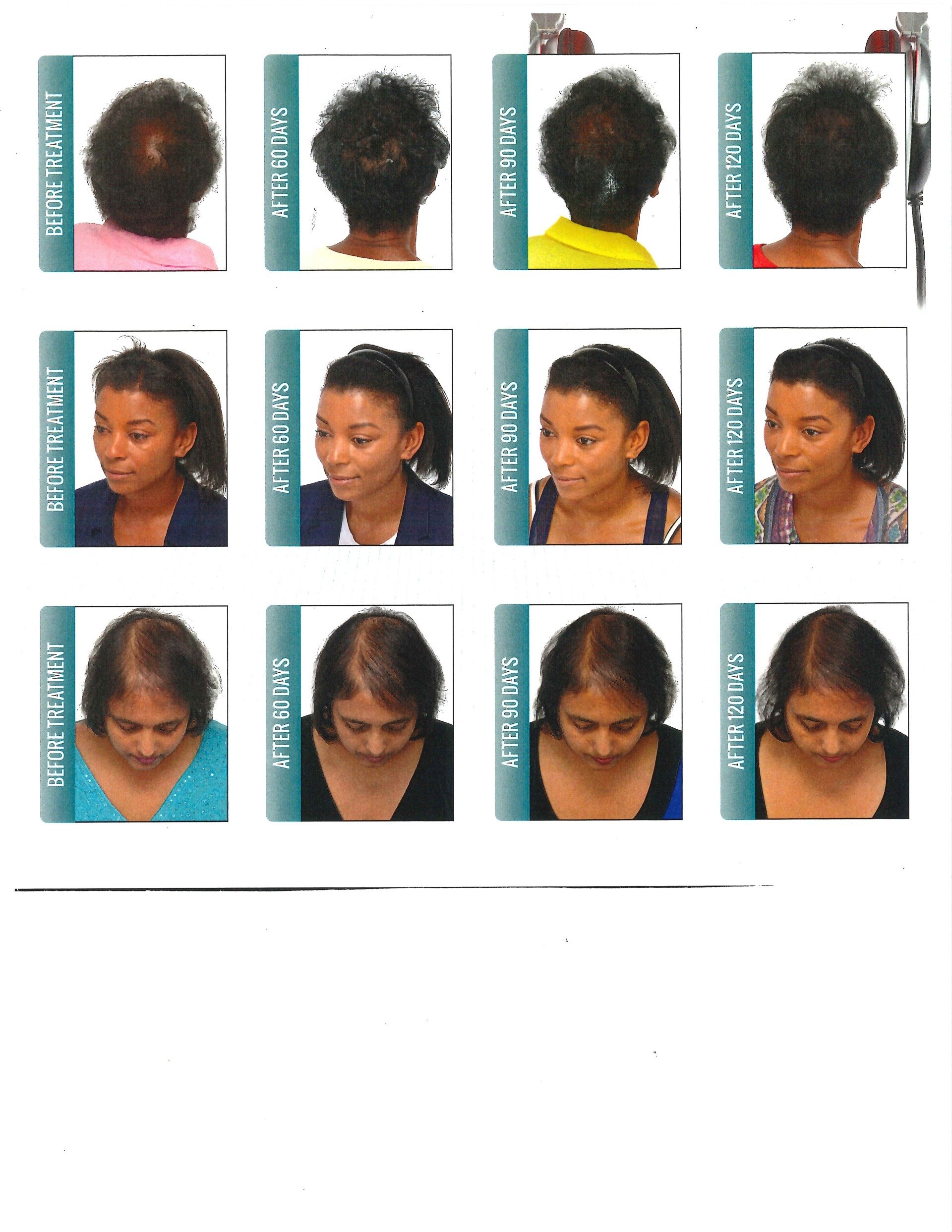 Hair Restoration - Troy, MI - Chambers Hair Institute