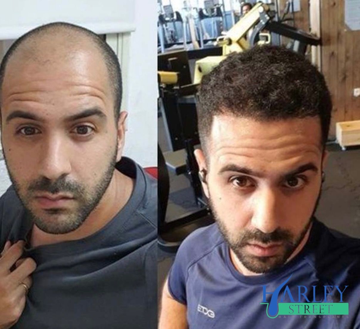 Hair Transplant Liverpool | Harley Street Liverpool