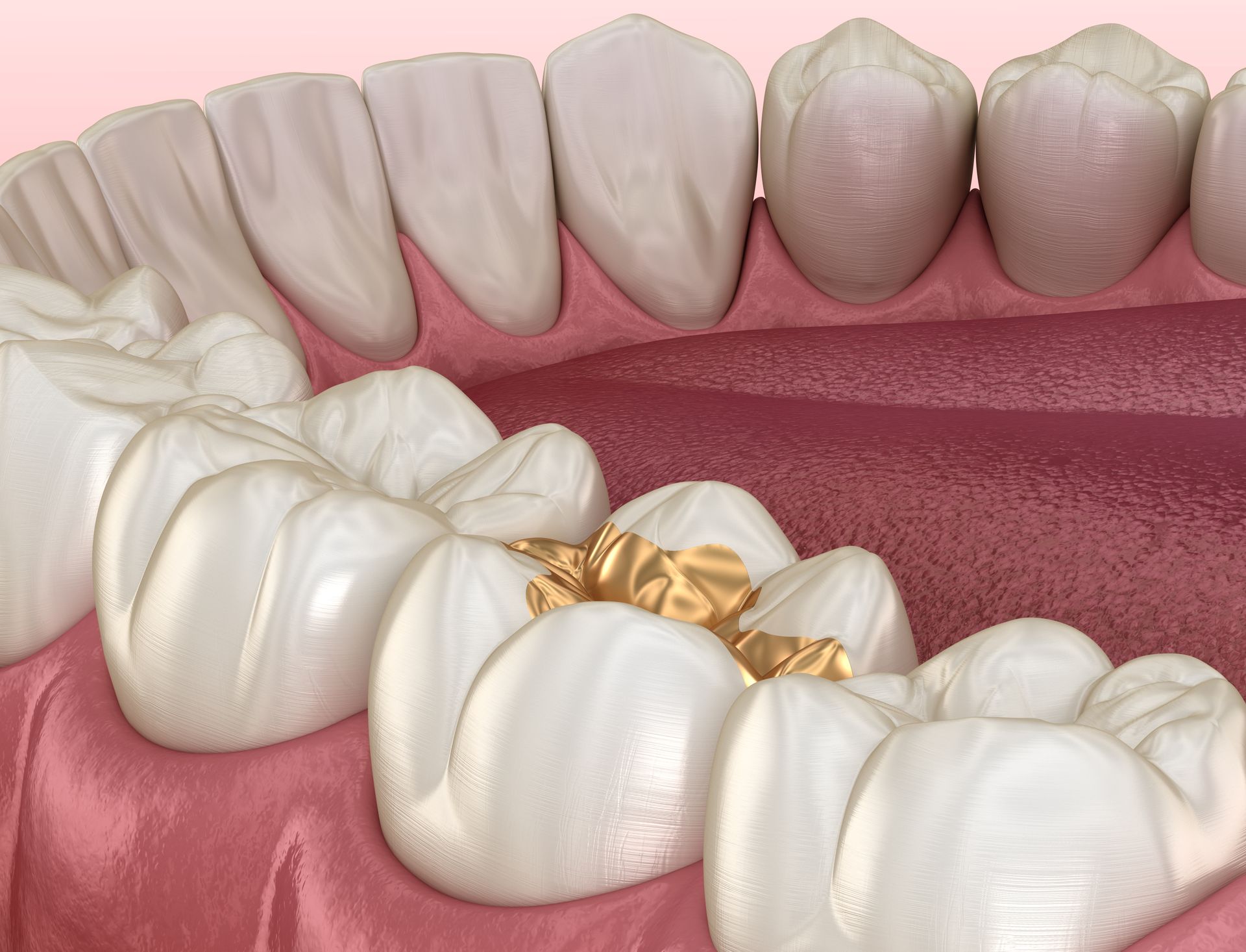 Dental Inlays in Westport: What You Need to Know