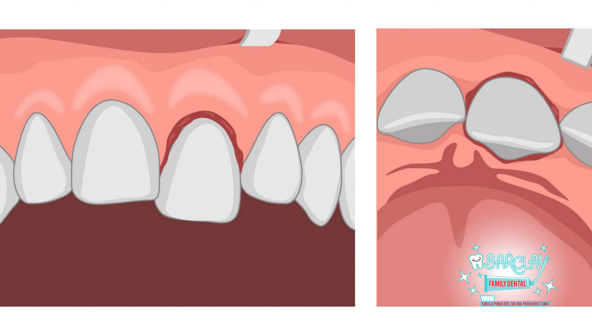 Tooth Luxation: Types, Causes, Symptoms, and Treatment