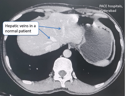 Budd-Chiari syndrome (Hepatic Vein Thrombosis) - DIPS procedure