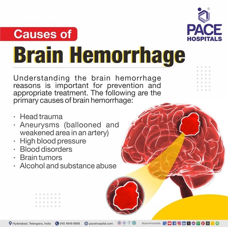 Brain Hemorrhage - Causes, Symptoms, Types, Treatment