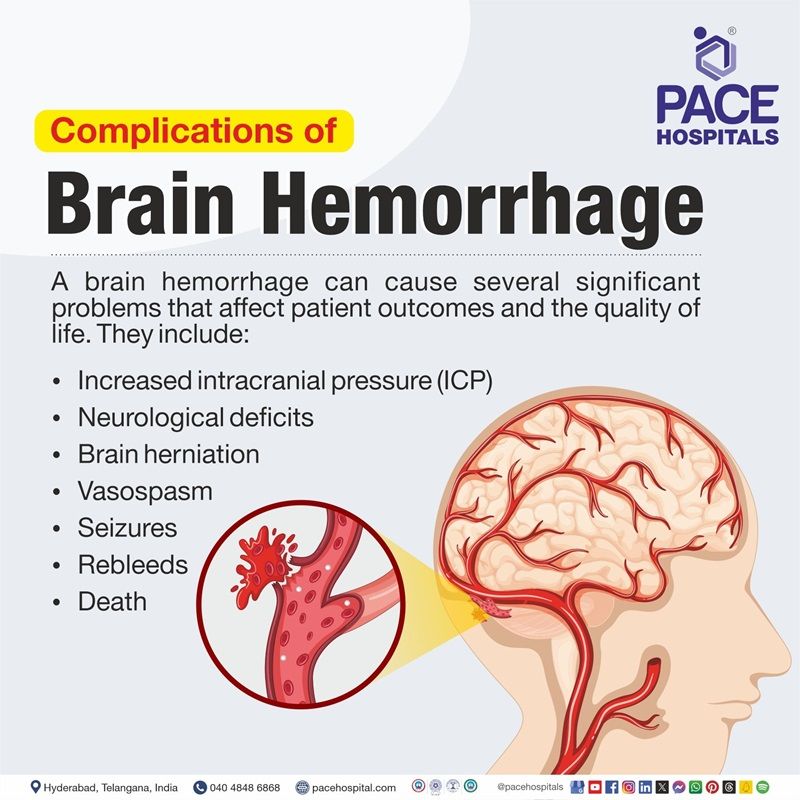 Brain Hemorrhage - Causes, Symptoms, Types, Treatment