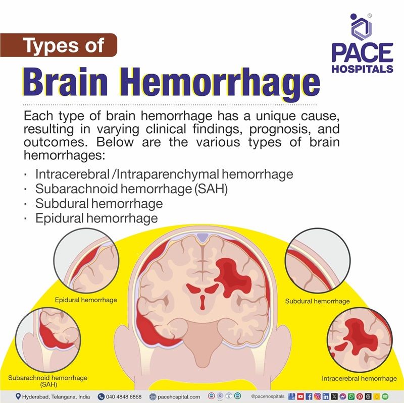 Brain Hemorrhage - Causes, Symptoms, Types, Treatment