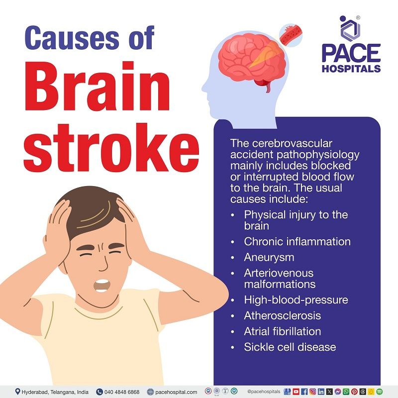 Brain Stroke: Types, Causes, Symptoms, Prevention & Treatment