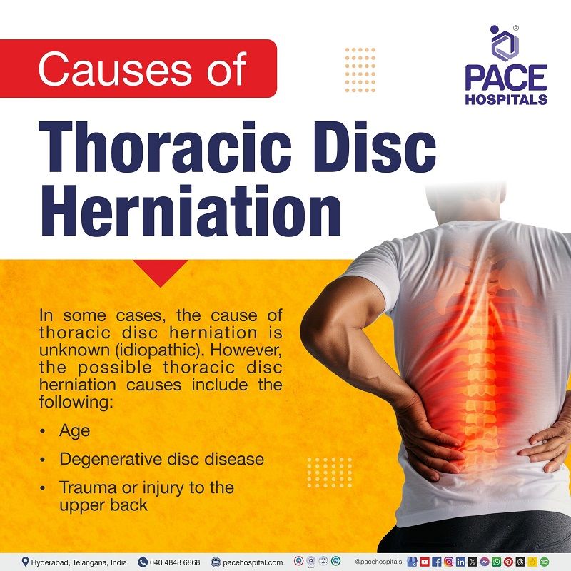Thoracic Disc Herniation - Symptoms, Causes and Preventions