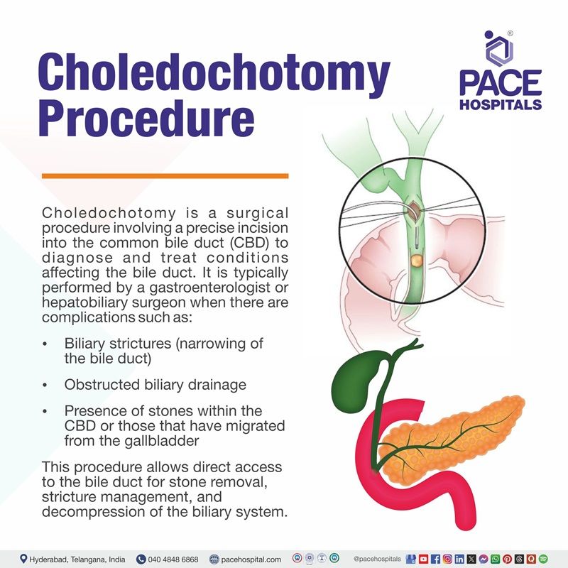 Best Hospital for Choledochotomy Procedure in Hyderabad, India